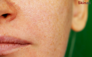 What is Pigmentation: it’s Causes, Treatment, and Everything you need ...